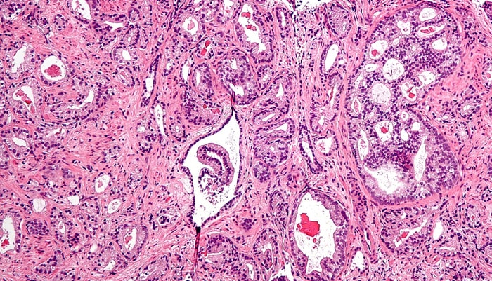 Cancer de la prostate: des avancées du côté de la résistance aux ...
