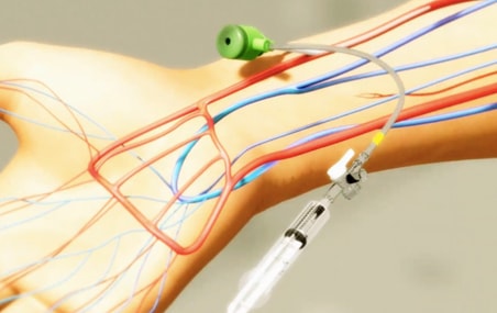 Artère radiale, voie royale